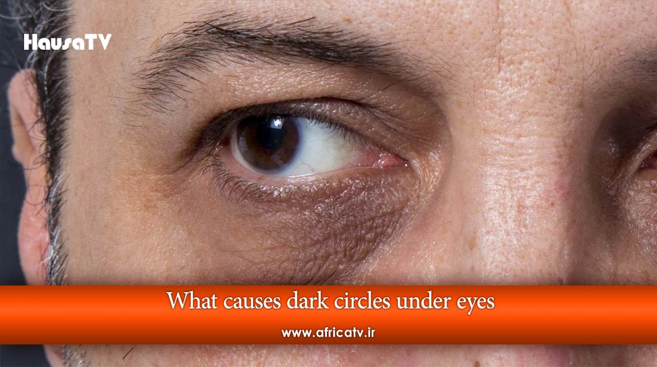What causes dark circles under eyes? | Urmedium